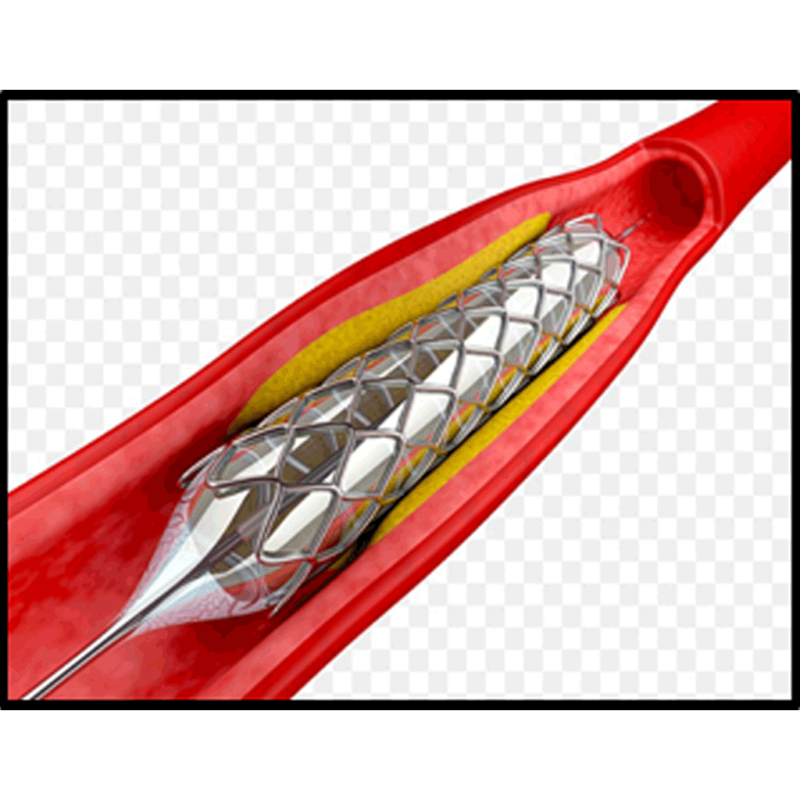 ANGIOPLASTY AND STENTING - PKLI&RC
