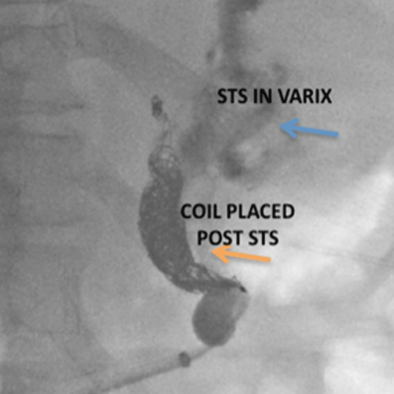 BALLOON-OCCLUDED RETROGRADE TRANSVENOUS OBLITERATION (BRTO) - PKLI&RC