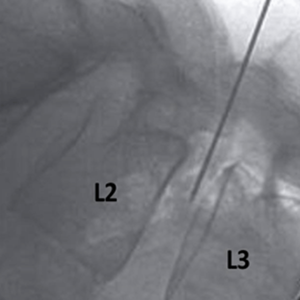 DISC ASPIRATION - PKLI&RC