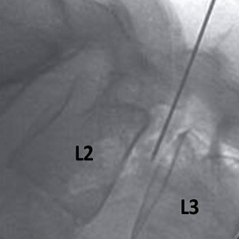 DISC ASPIRATION - PKLI&RC