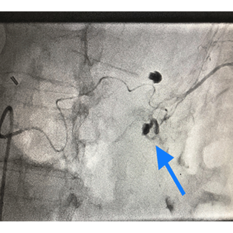EMBOLIZATION FOR GASTROINTESTINAL TRACT BLEEDING - PKLI&RC