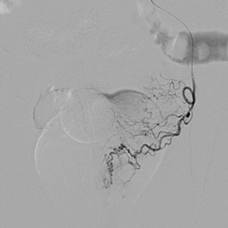 EMBOLISATION OF THE PROSTATIC ARTERIES - PKLI&RC