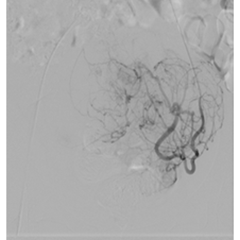 EMBOLISATION FOR UTERINE FIBROIDS - PKLI&RC
