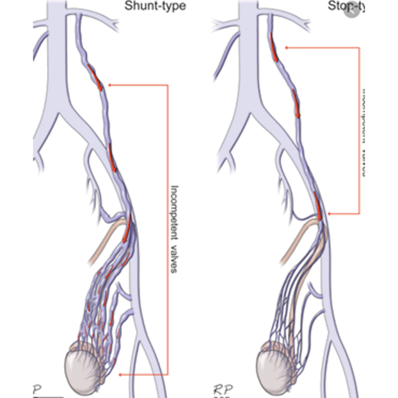 EMBOLISATION FOR VARICOCELES - PKLI&RC