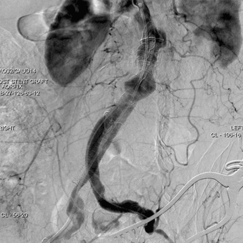ENDOVASCULAR TREATMENT OF ABDOMINAL AORTIC ANEURYSMS (EVAR) - PKLI&RC