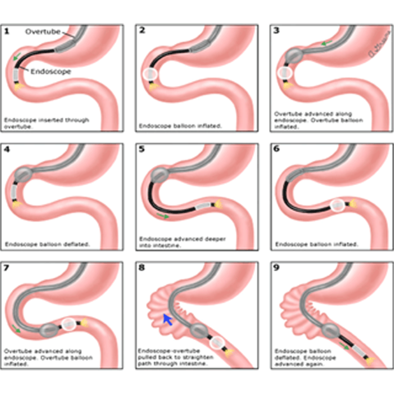 INTERVENTIONAL ENDOSCOPY – PKLI&RC