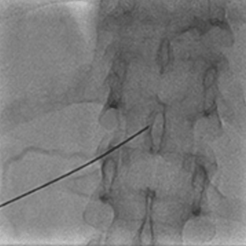 INFILTRATIONS AND GUIDED INJECTIONS FOR CHRONIC & ACUTE PAIN MANAGEMENT ...