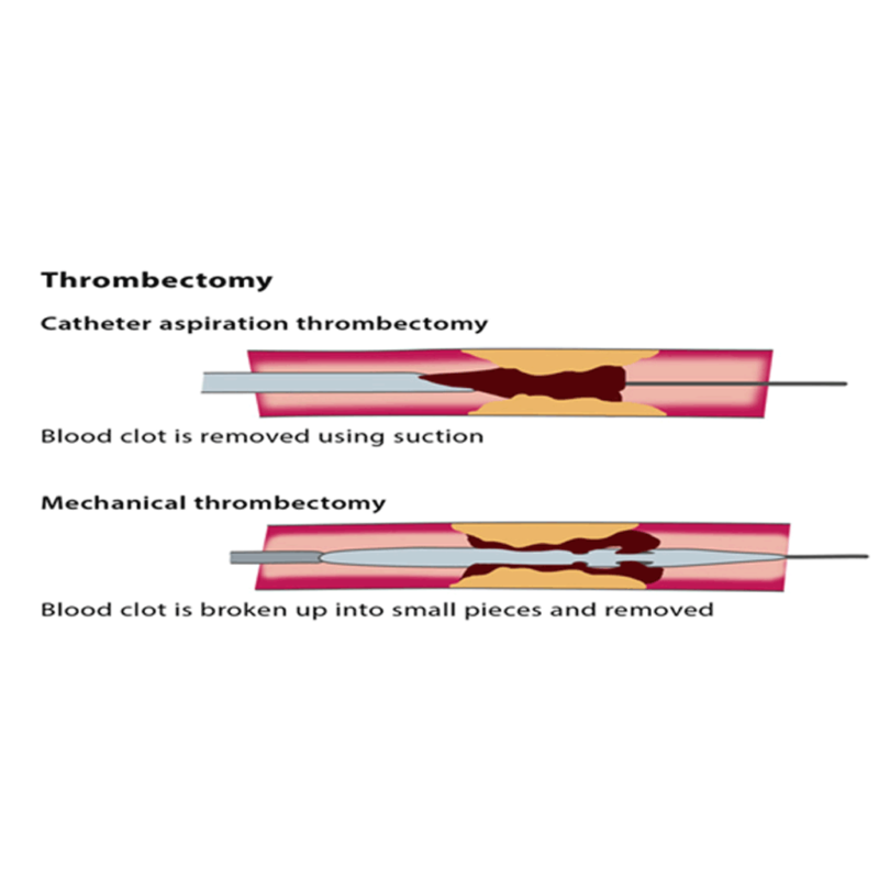 THROMBECTOMY - PKLI&RC