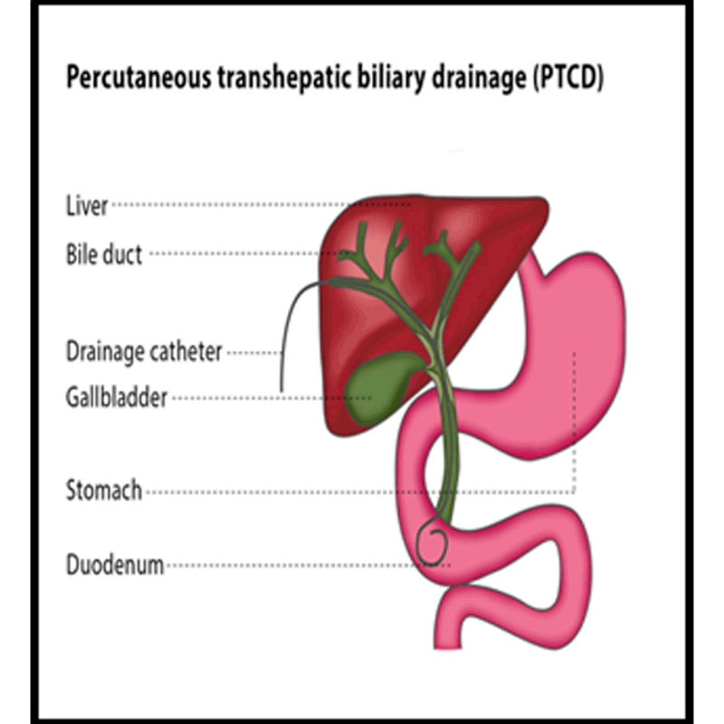 BILIARY PROCEDURES - PKLI&RC